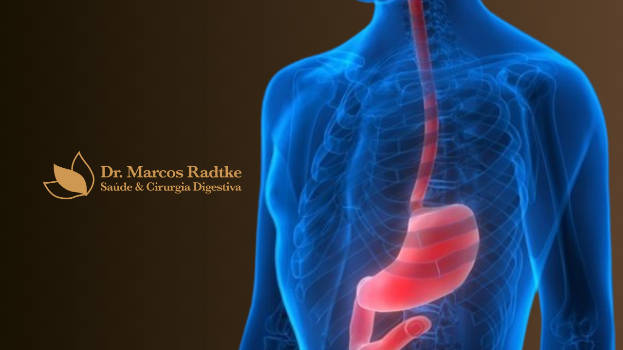 Acalasia de esôfago: O que você precisa saber - Dr. Marcos Radkte